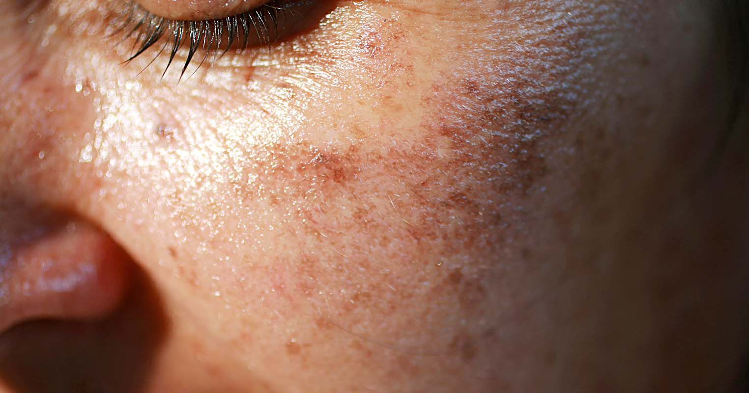 What Is Uneven Skin Tone | Cetaphil HK