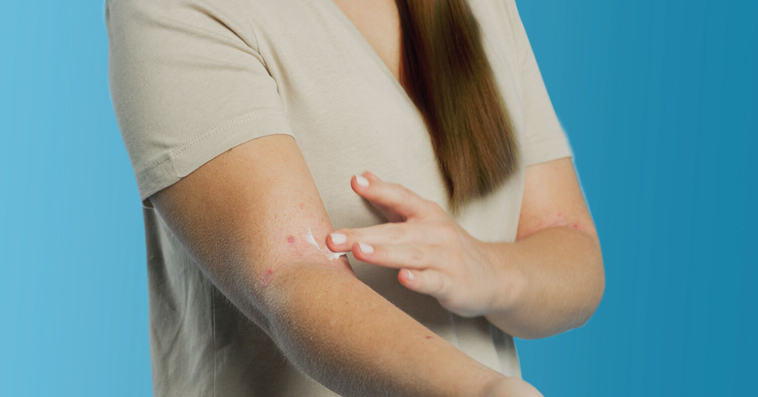 What Causes Eczema Flare-Ups? | Cetaphil HK
